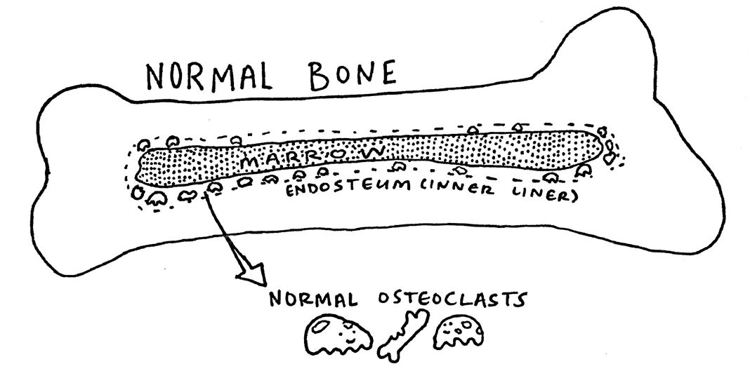 Diagnosis – CRMO Awareness