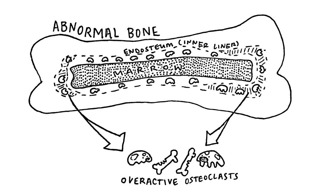 Diagnosis – CRMO Awareness