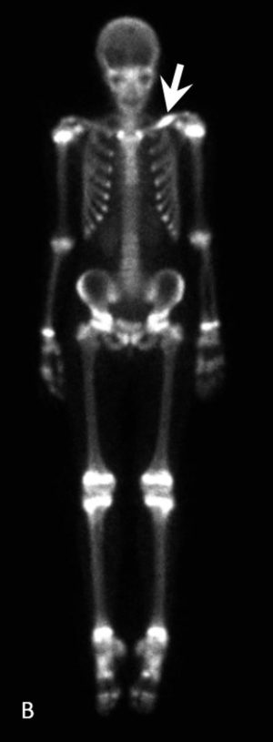 Diagnosis – CRMO Awareness