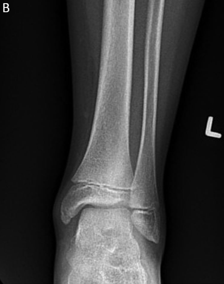 Diagnosis – CRMO Awareness